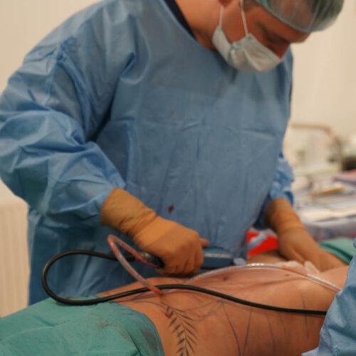 Liposuction Vaser HD 4D - Cost, Effects • OT.CO Poland