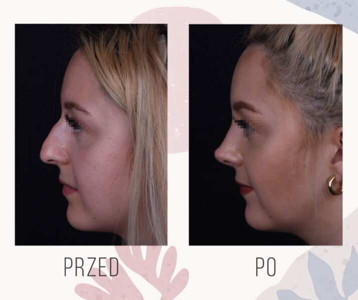 Nose correction surgery (Rhinoplasty) • OT.CO Poland