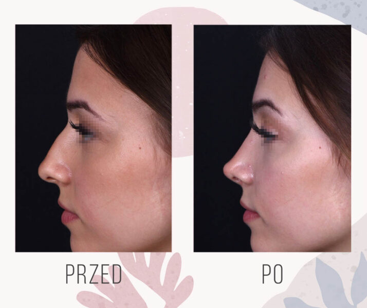 Nose correction surgery (Rhinoplasty) • OT.CO Poland