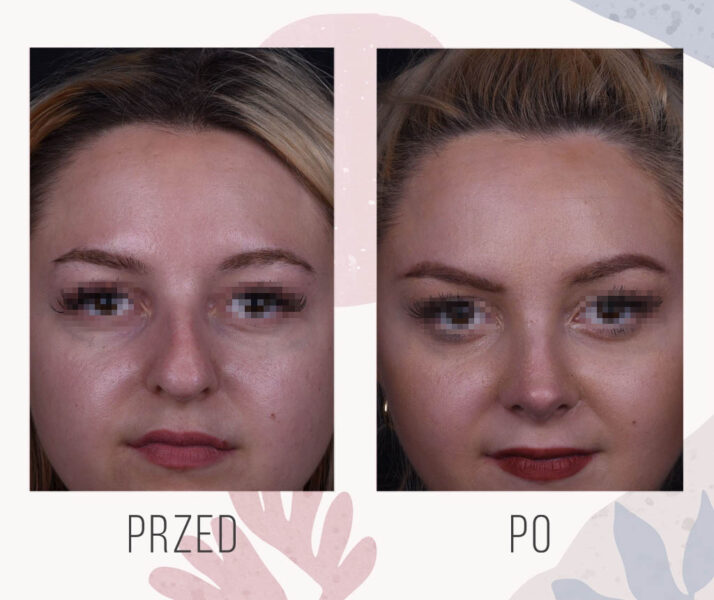 Nose correction surgery (Rhinoplasty) • OT.CO Poland