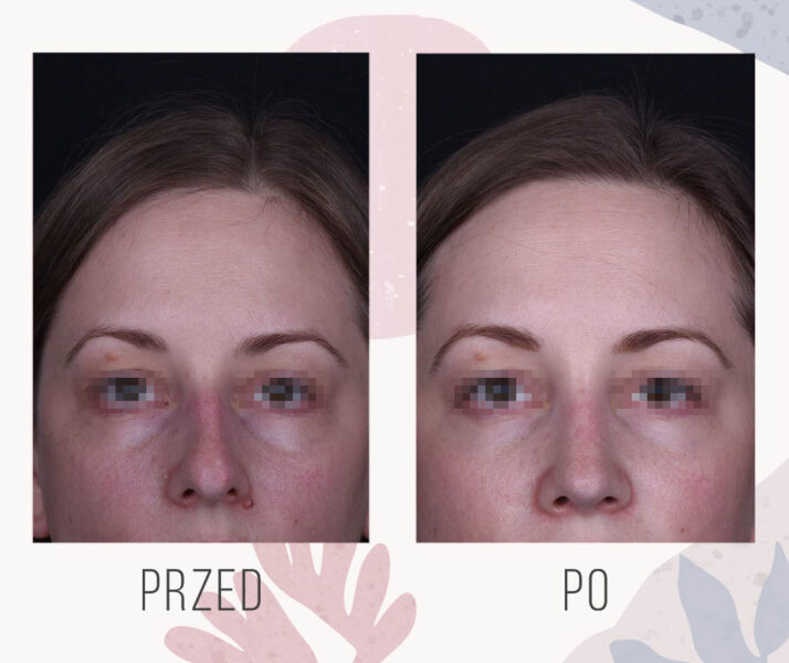 Nose correction surgery (Rhinoplasty) • OT.CO Poland