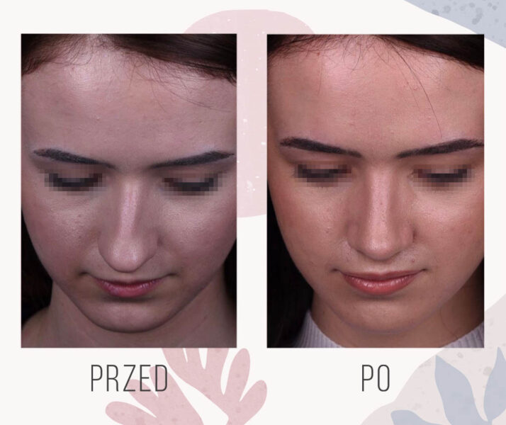 Nose correction surgery (Rhinoplasty) • OT.CO Poland