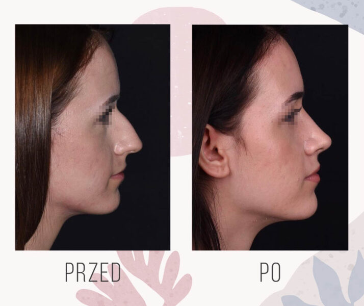 Nose correction surgery (Rhinoplasty) • OT.CO Poland