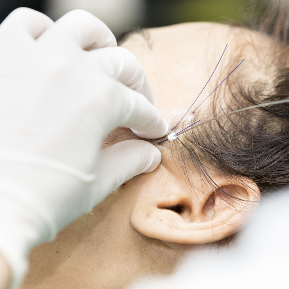 PDO Threads - Cost, Before and After • OT.CO Poland