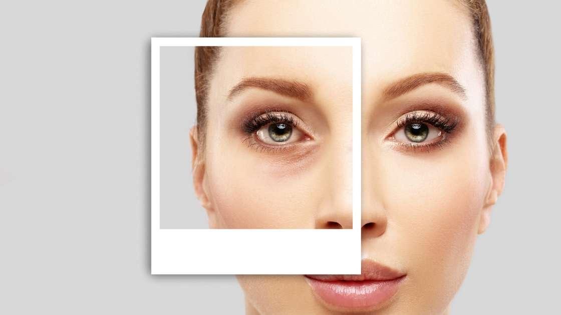 Eyelid plasty after the procedure: how long does the recovery last ...
