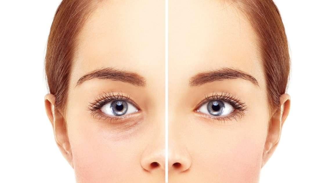 Eyelid plasty day by day - what is worth knowing? • OT.CO Clinic