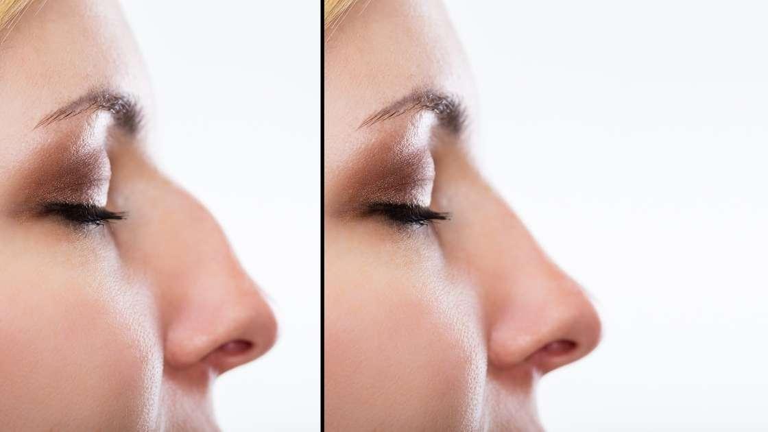 Is nasal hump surgery safe? • OT.CO Clinic