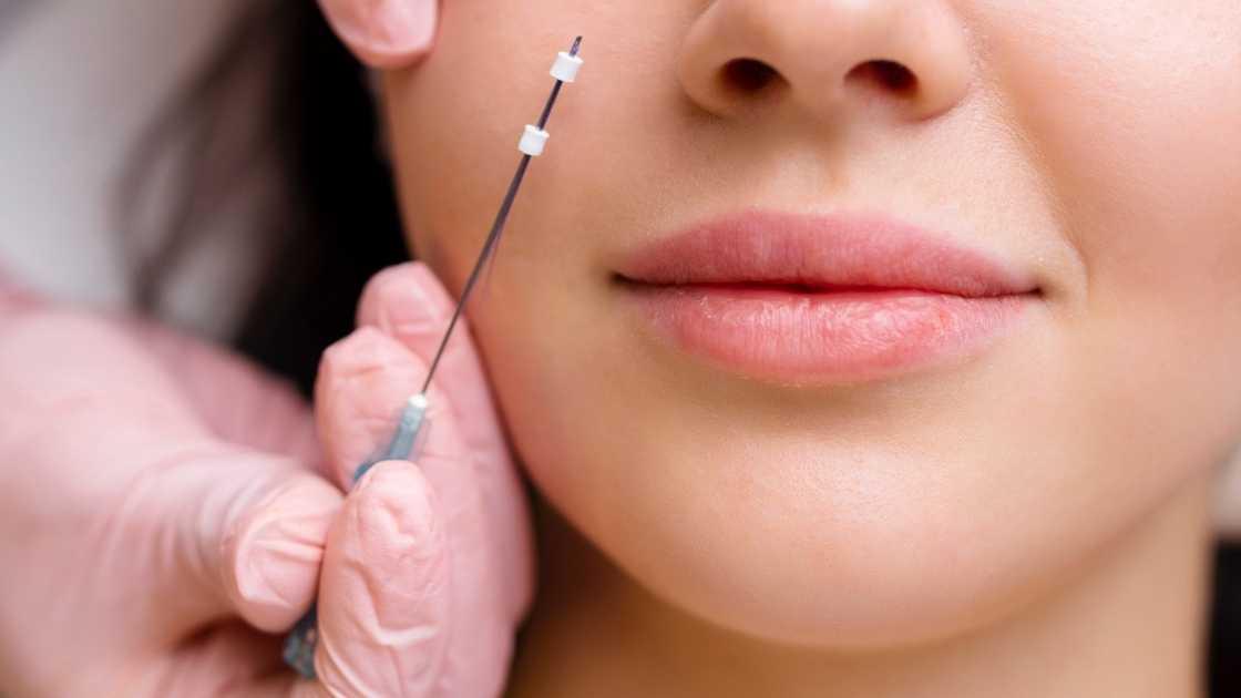 PDO threads effects: How long do the results last? • OT.CO Clinic