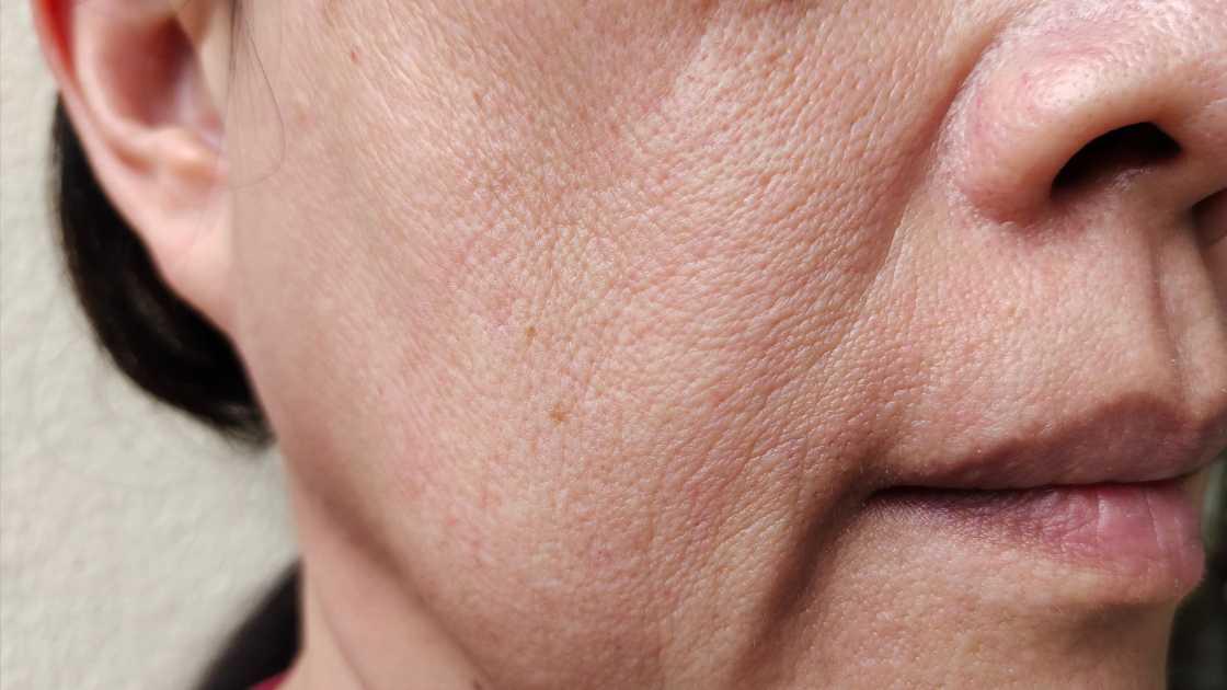 Marionette wrinkles - what are they and how to combat them? • OT.CO Clinic