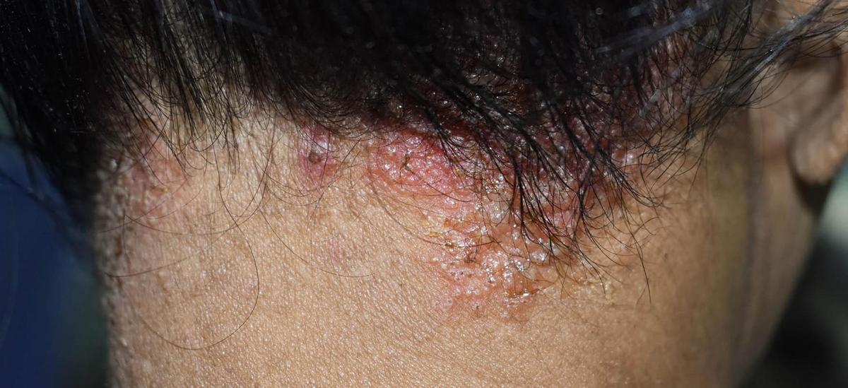 Ringworm of the scalp - how to recognize and effectively treat it? • OT ...