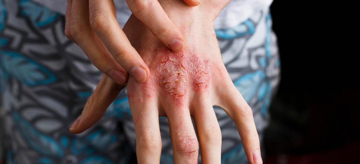 Seborrheic dermatitis - causes, diet • OT.CO Clinic