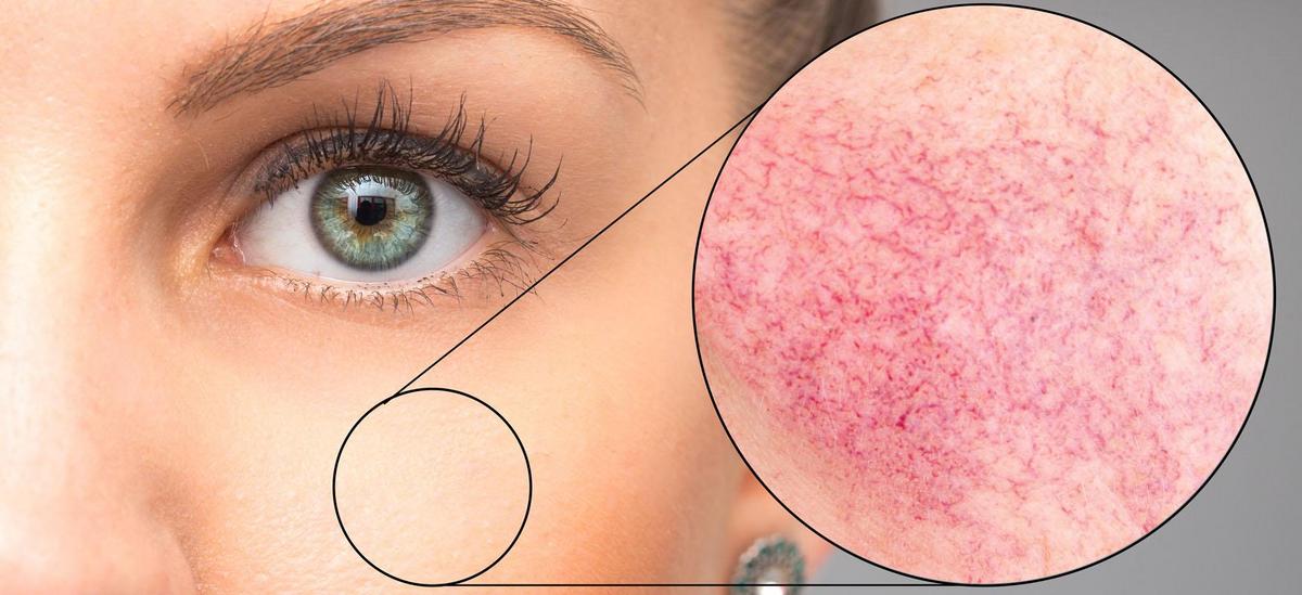 Acne rosacea - causes and effective treatments • OT.CO Clinic