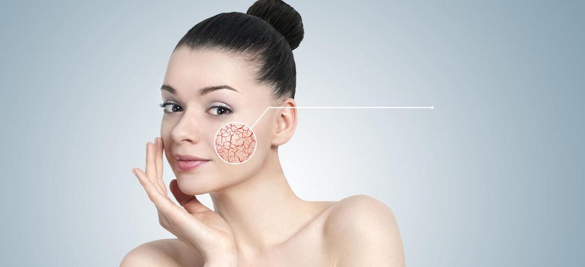 Cracking blood vessels on the face - causes, home remedies • OT.CO Clinic