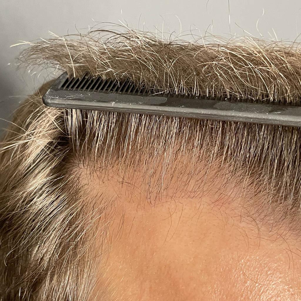 Hair transplant - a pill of knowledge • OT.CO Clinic