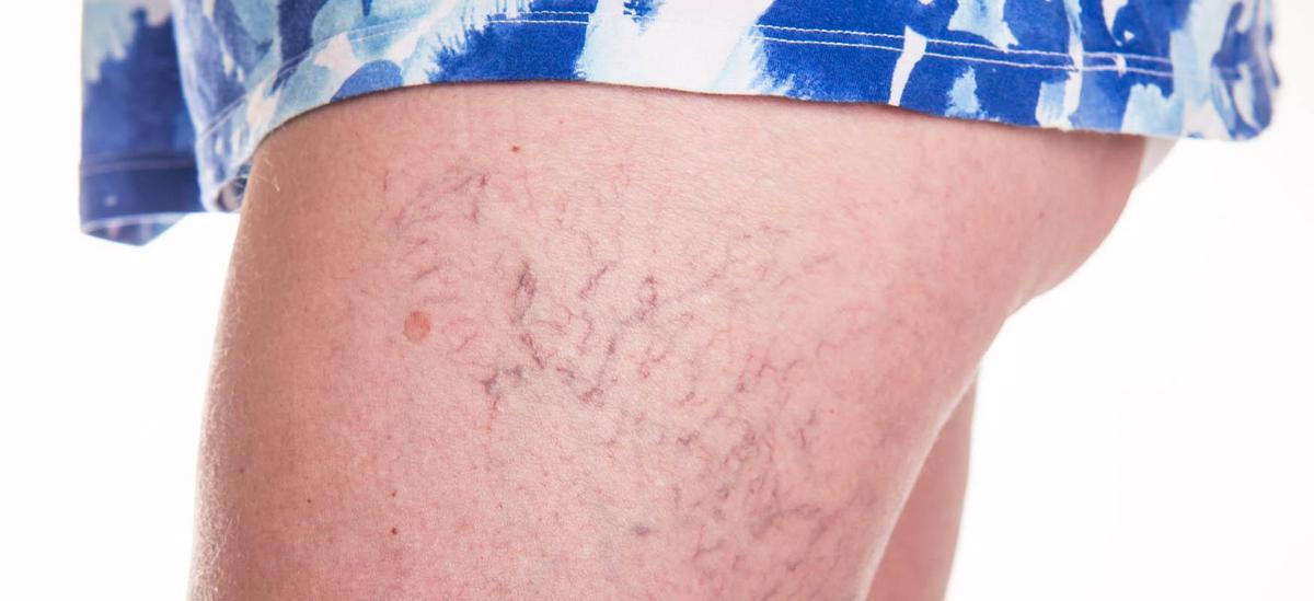 How to get rid of burst blood vessels on the legs? • OT.CO Clinic