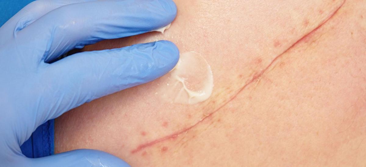How to take care of scars after treatments at home and in the office ...