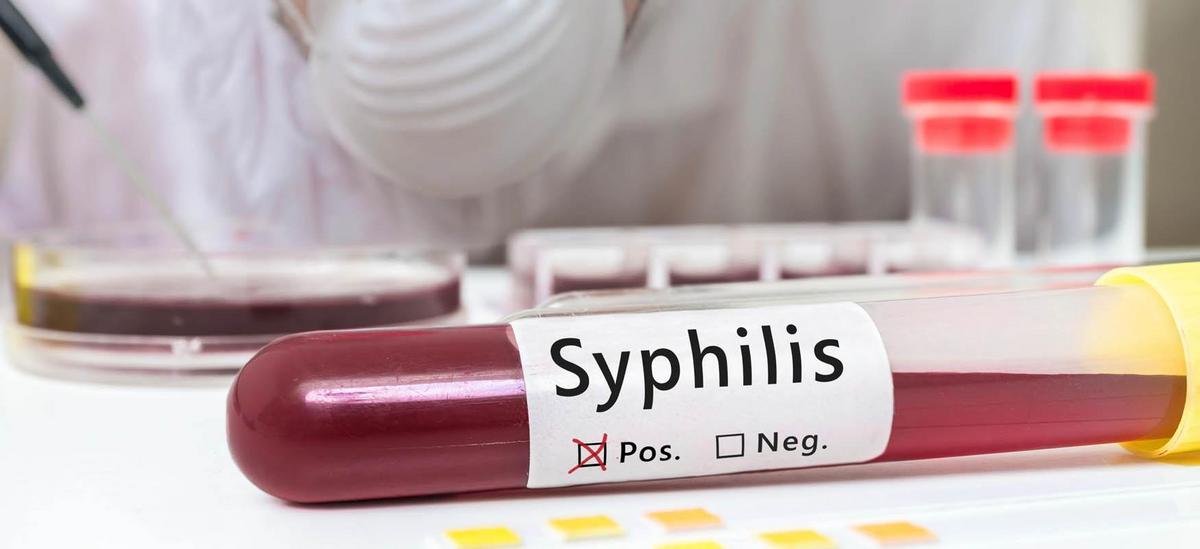 Syphilis - symptoms, routes of infection and treatment methods • OT.CO ...