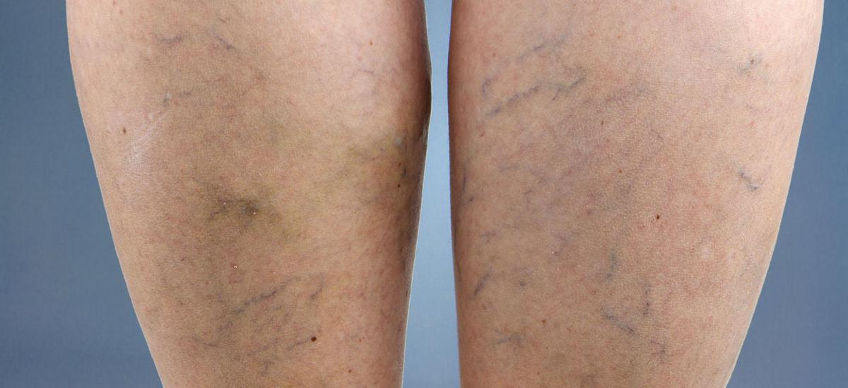 Varicose veins on legs - symptoms, treatment methods • OT.CO Clinic